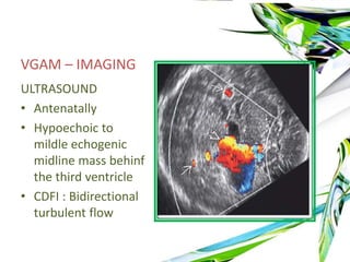 Vascular Malformations Of CNS Radiology | PPTX
