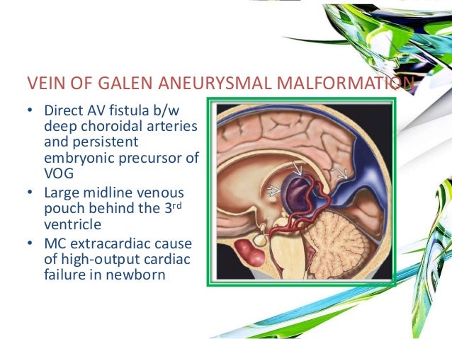 Vascular Malformations Of CNS Radiology