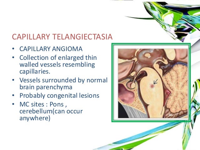 Vascular Malformations Of CNS Radiology