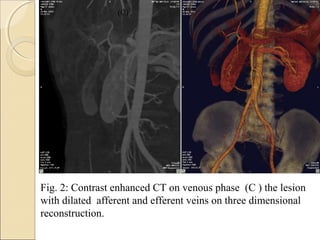 AVM in LIVER, Dr TRAN NGAN CHAU-Dr PHAN THANH HAI | PPT | Blood ...