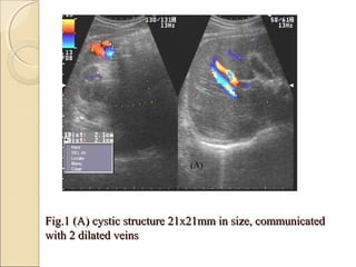 AVM in LIVER, Dr TRAN NGAN CHAU-Dr PHAN THANH HAI | PPT | Blood ...