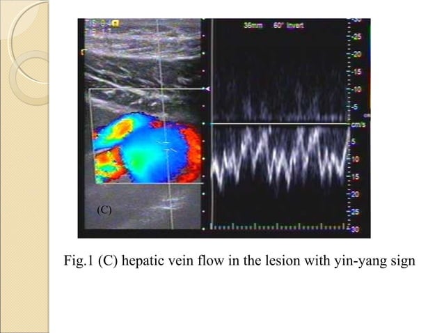 AVM in LIVER, Dr TRAN NGAN CHAU-Dr PHAN THANH HAI | PPT