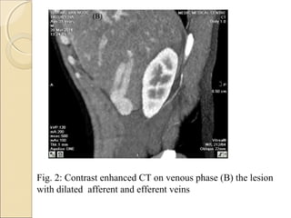 AVM in LIVER, Dr TRAN NGAN CHAU-Dr PHAN THANH HAI | PPT | Blood ...