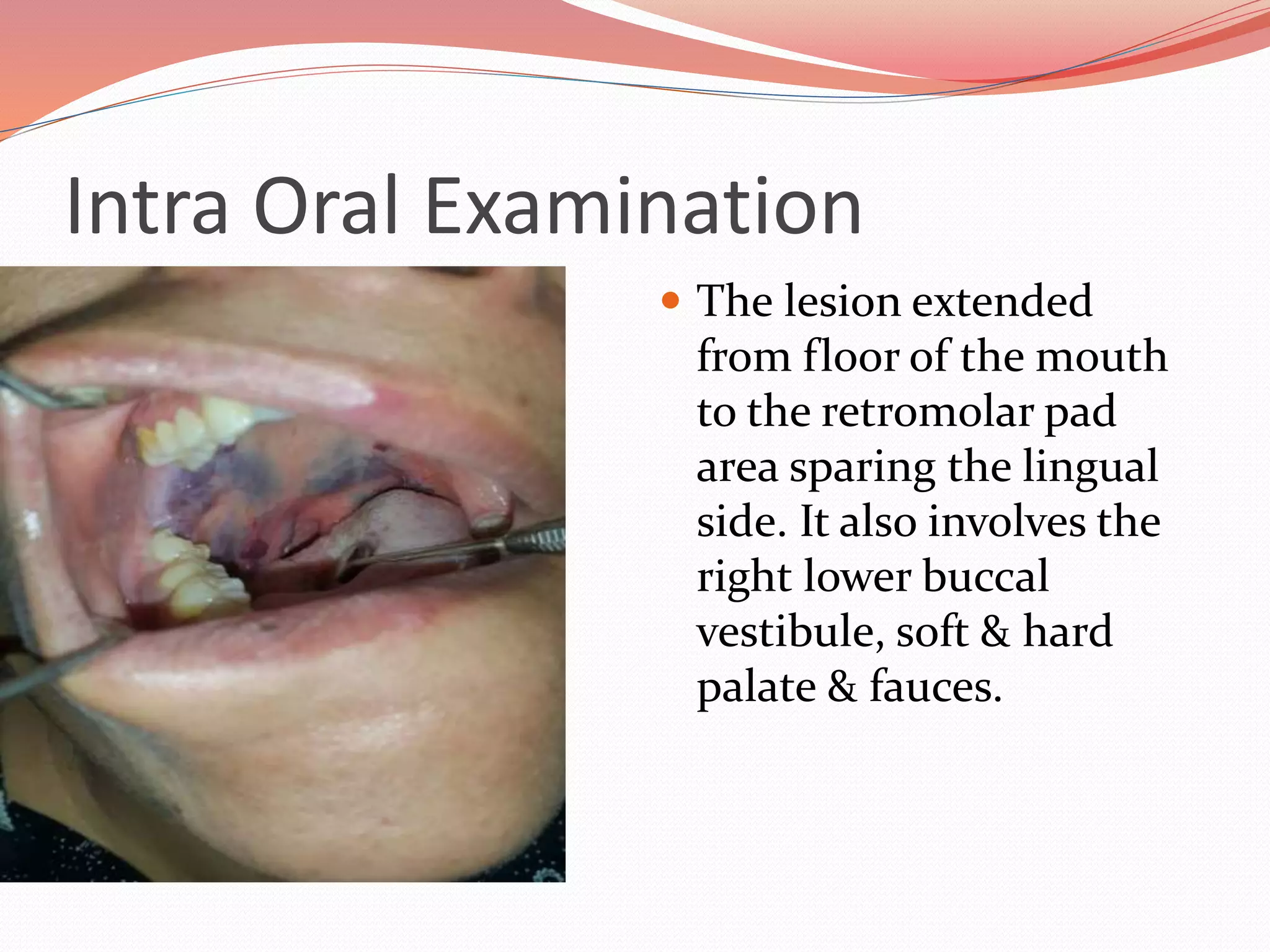 Av malformation | PPTX