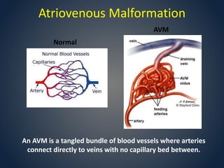 Avm and cellebellar hermorrege | PPT