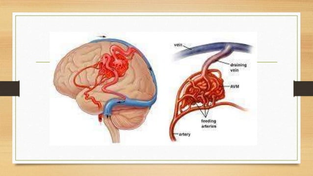 AVM Brain.pptx