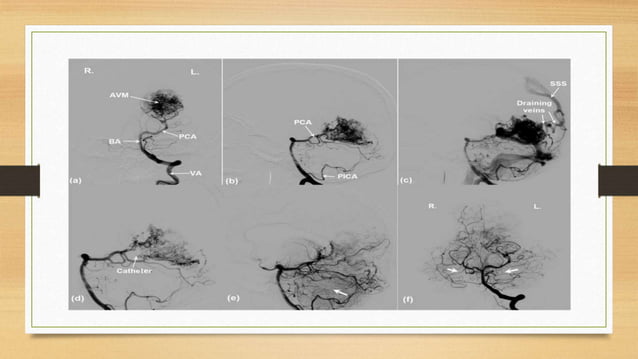 AVM Brain.pptx