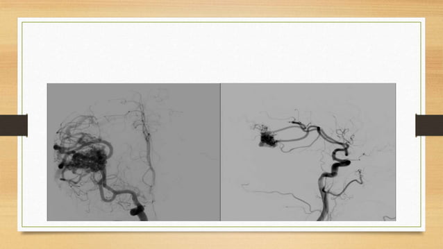 AVM Brain.pptx