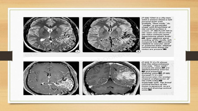 AVM Brain.pptx