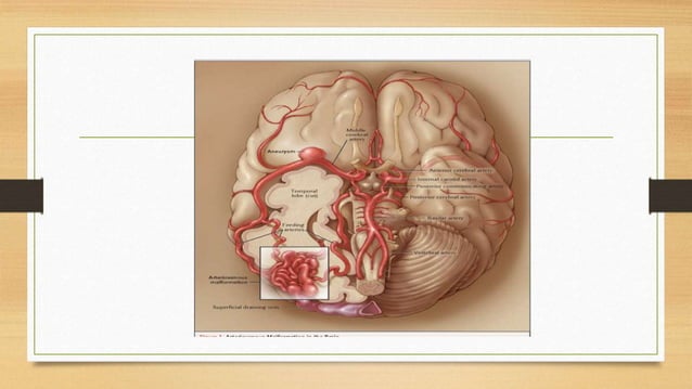 AVM Brain.pptx