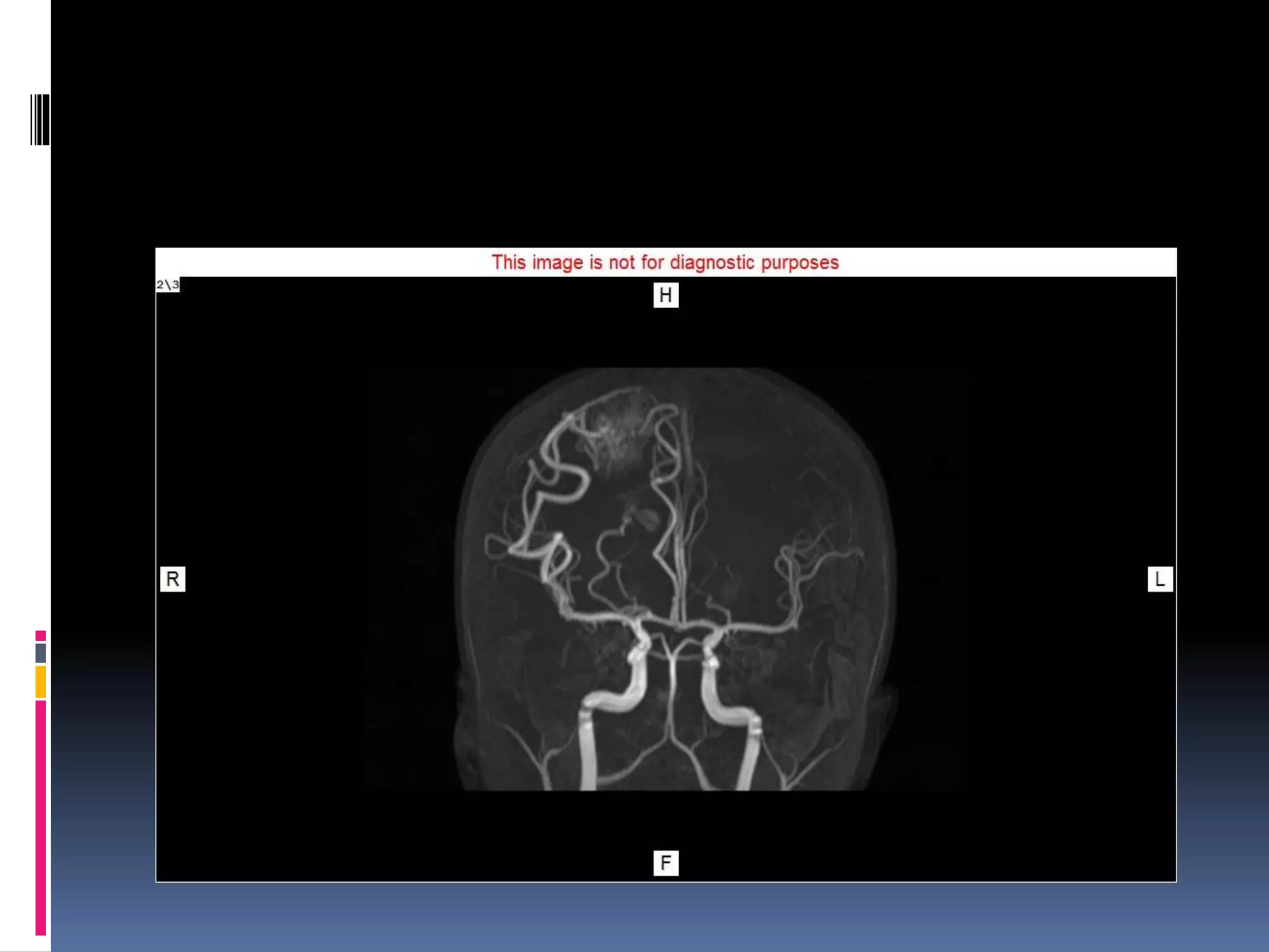 Brain Avms Pptx