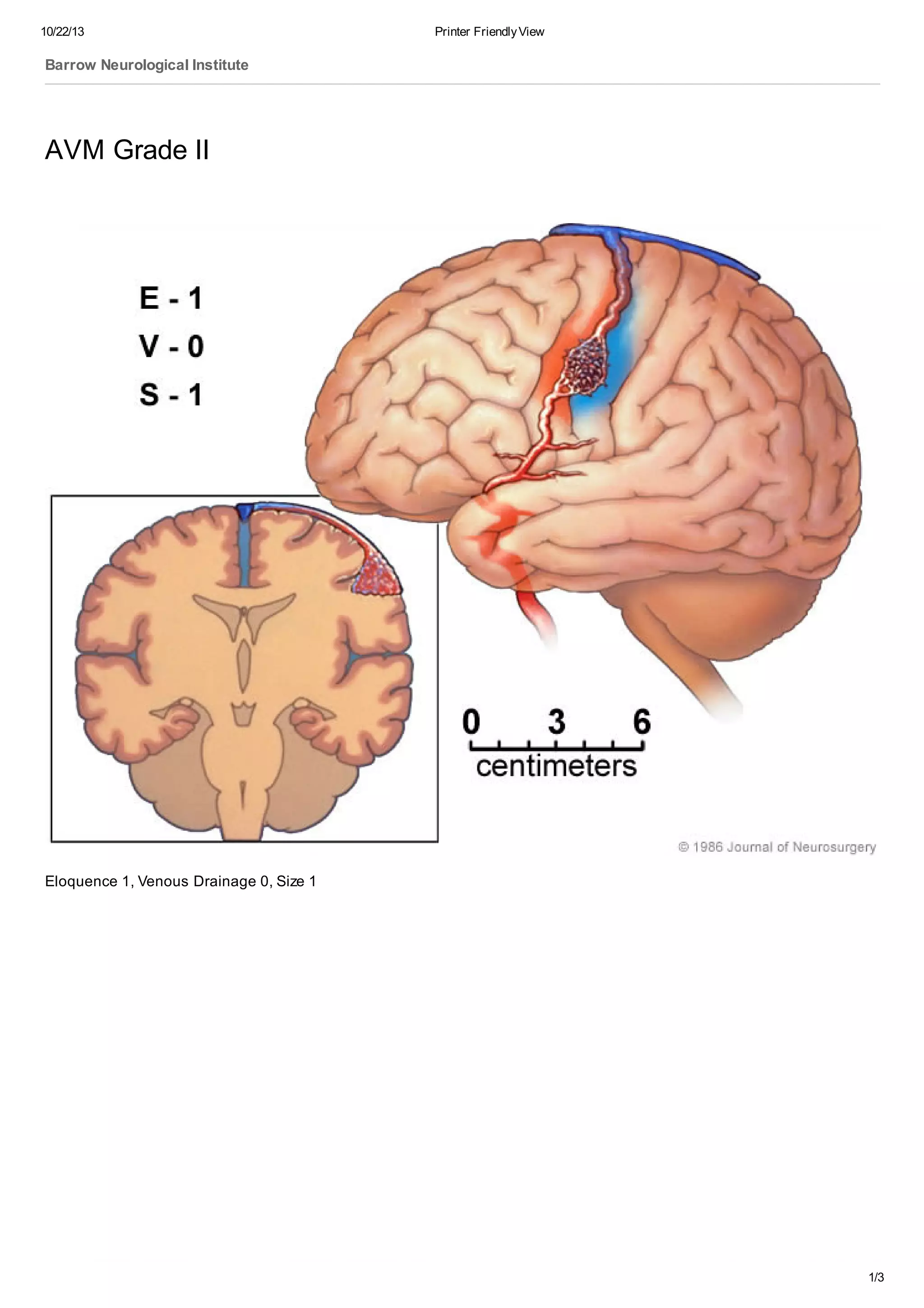 Avm spetzler grading | PDF | Diseases and Conditions | Medical Health