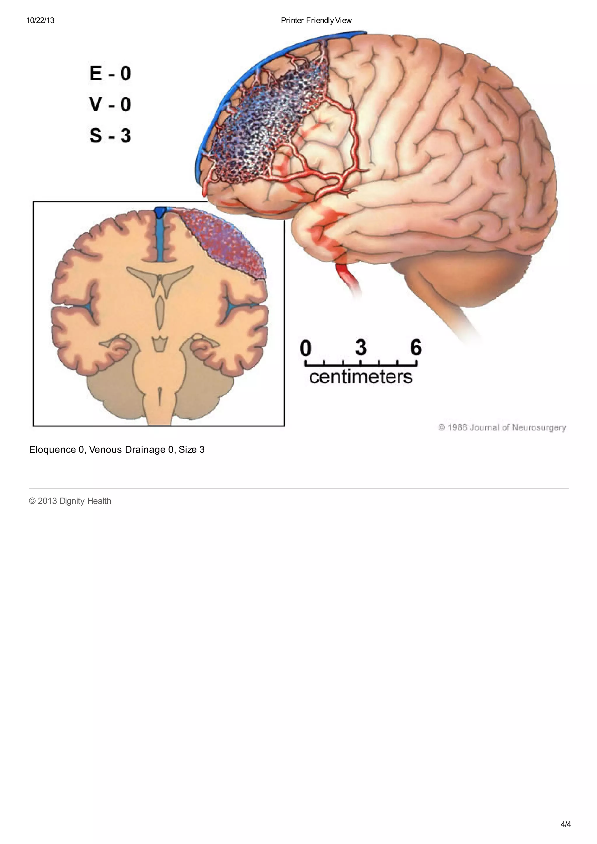 Avm spetzler grading | PDF | Diseases and Conditions | Medical Health