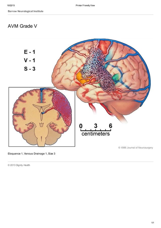 Avm spetzler grading | PDF | Diseases and Conditions | Medical Health