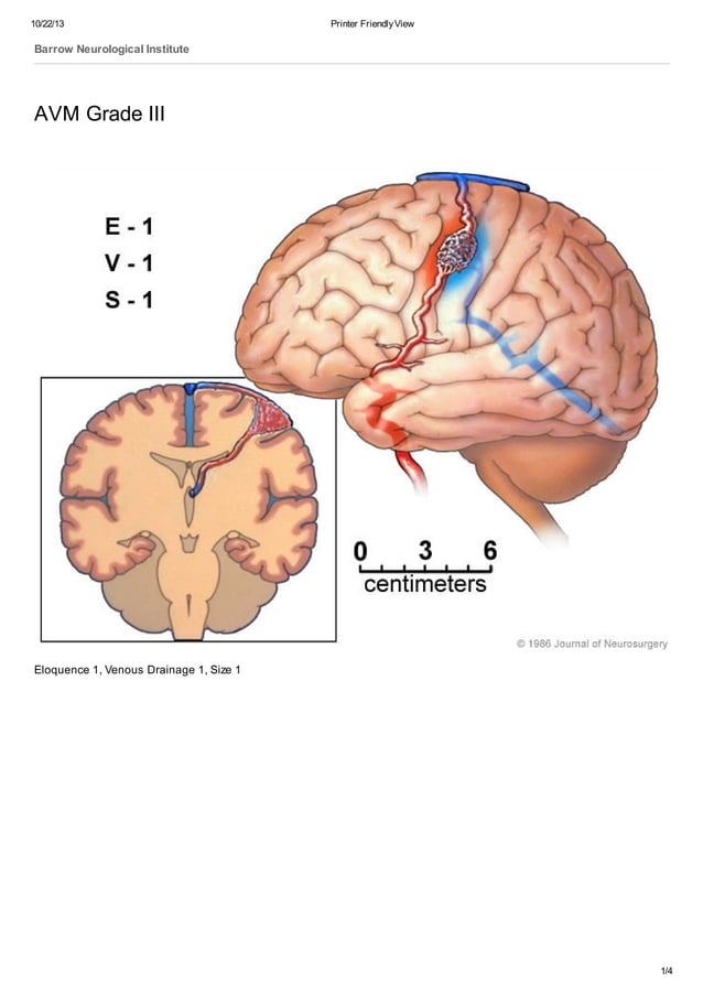 Avm spetzler grading | PDF | Diseases and Conditions | Medical Health