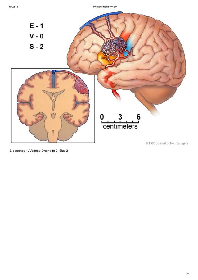 Avm spetzler grading | PDF | Diseases and Conditions | Medical Health