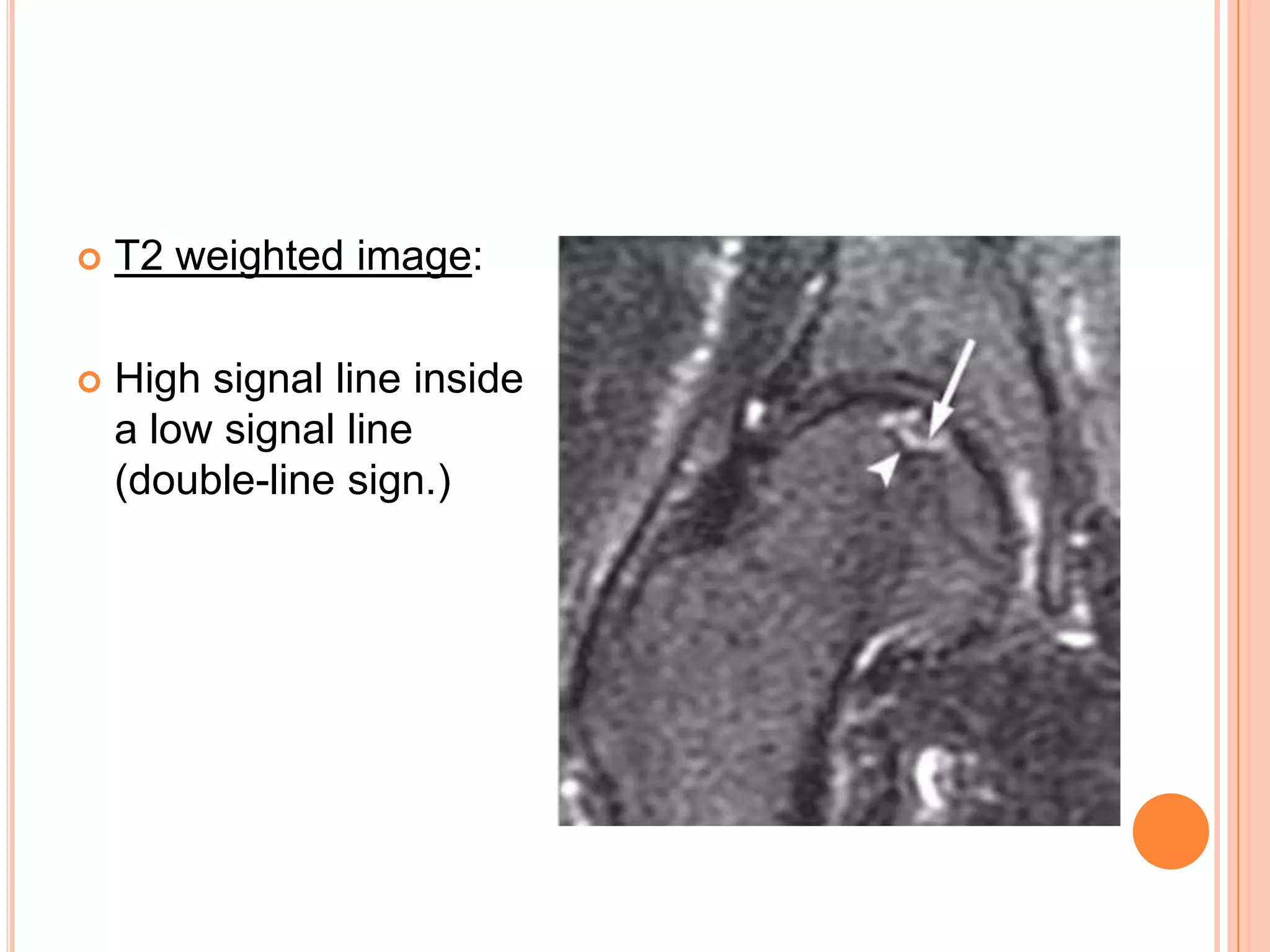 Avascular Necrosis of the Femoral Head | PPTX