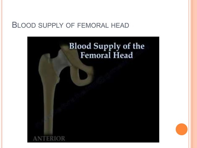 Avascular Necrosis of the Femoral Head | PPTX | Bone and Joint ...