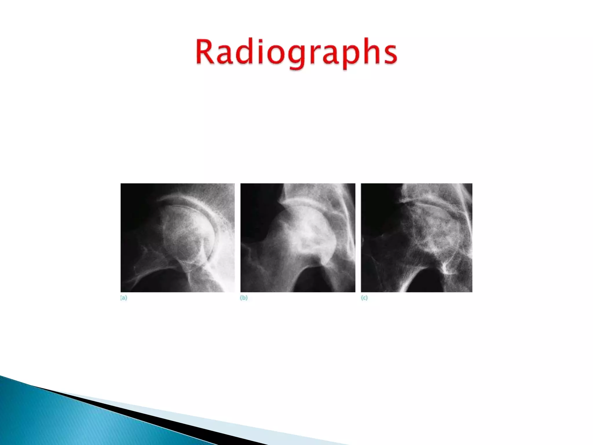 Avascular Necrosis (AVN) | PPTX
