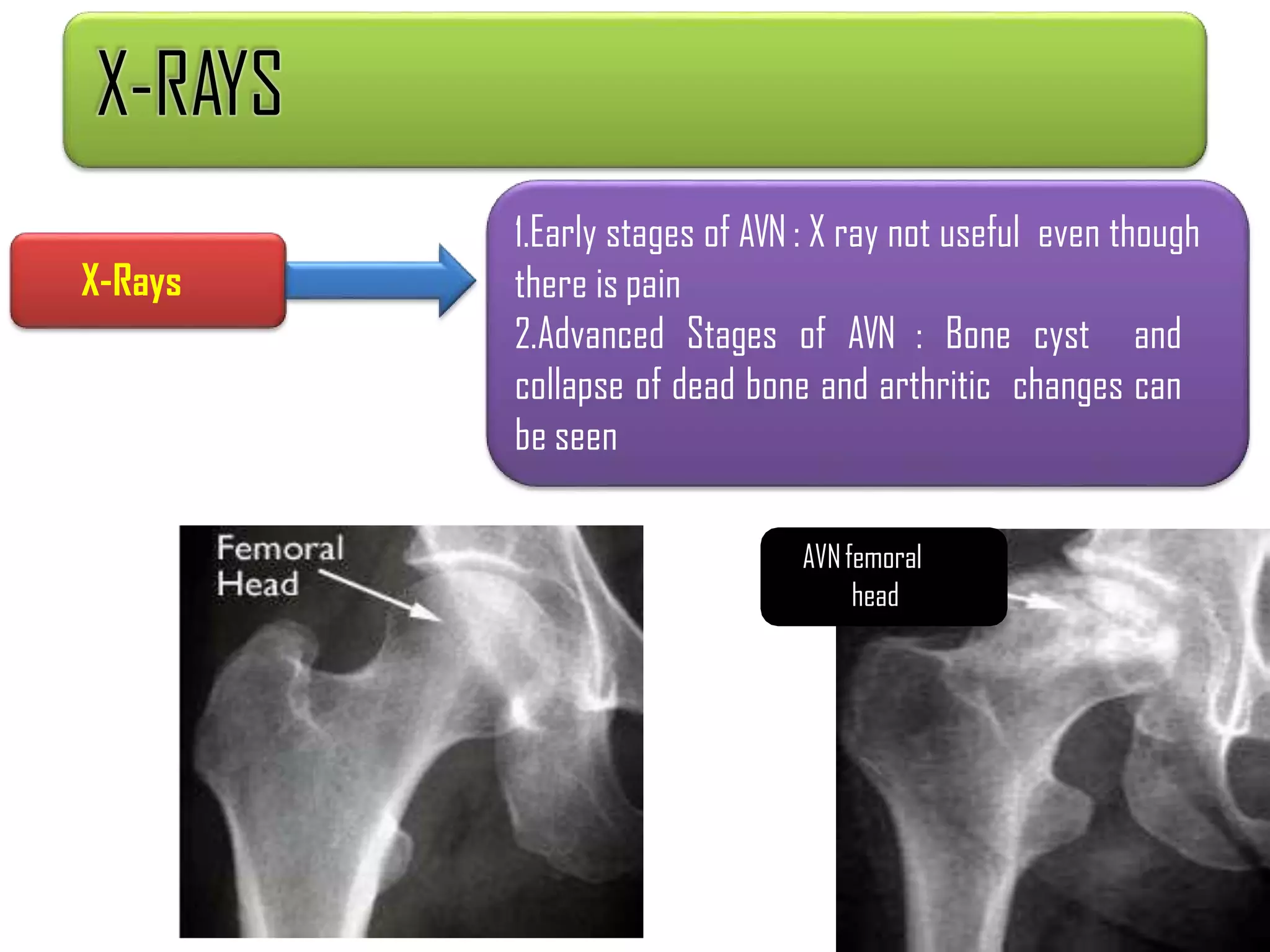Femoral Head Avascular Necrosis - Dr Rohit Bhaskar | PDF
