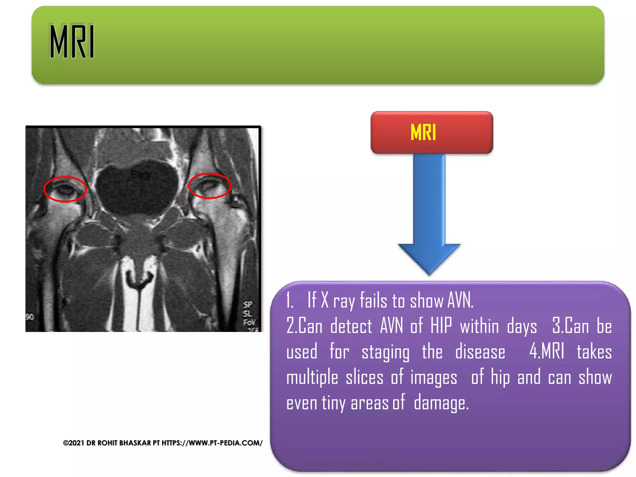Femoral Head Avascular Necrosis - Dr Rohit Bhaskar | PDF
