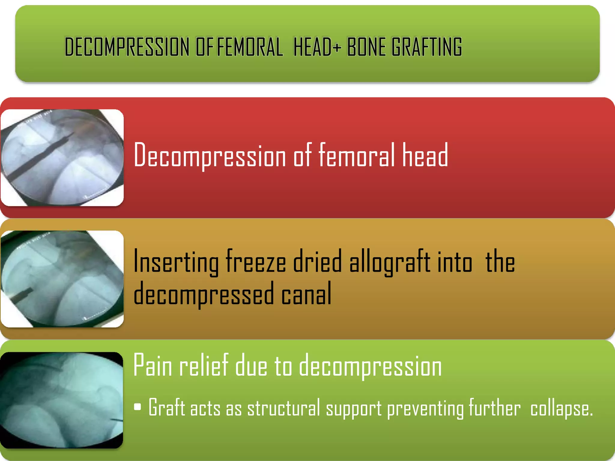 Femoral Head Avascular Necrosis - Dr Rohit Bhaskar | PDF
