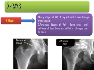 Femoral Head Avascular Necrosis - Dr Rohit Bhaskar | PDF