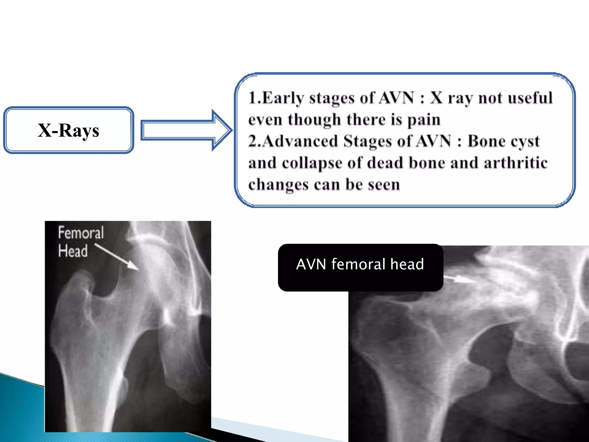 Avascular necrosis of femur | PPTX