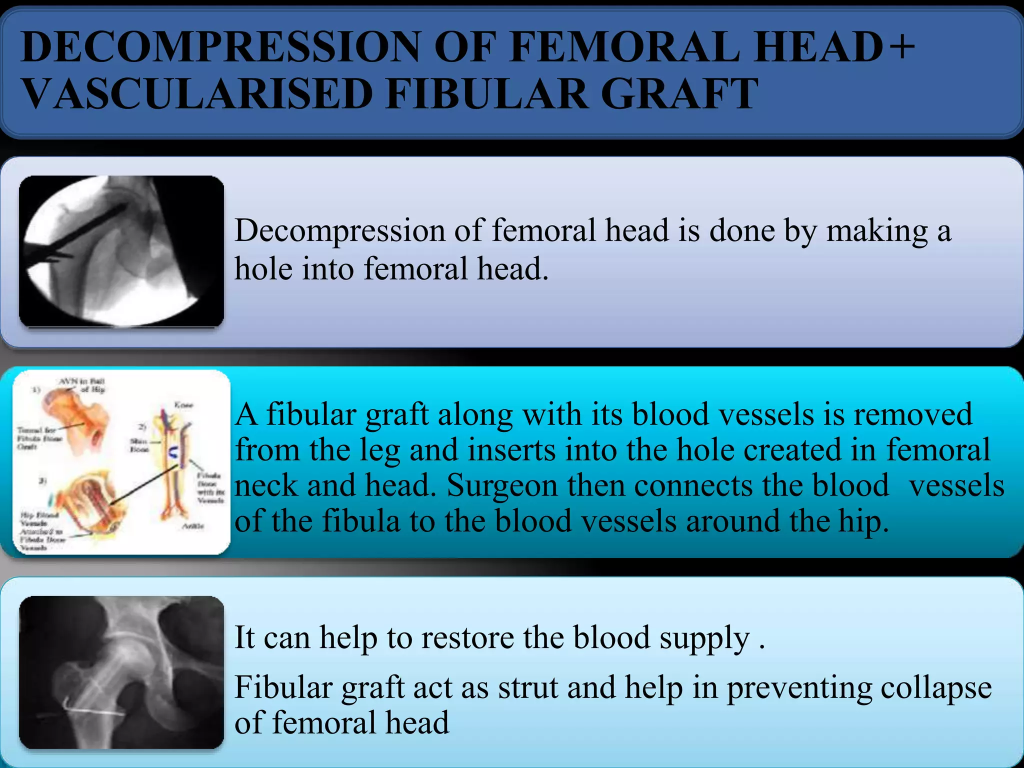 Avascular necrosis of femur | PPTX