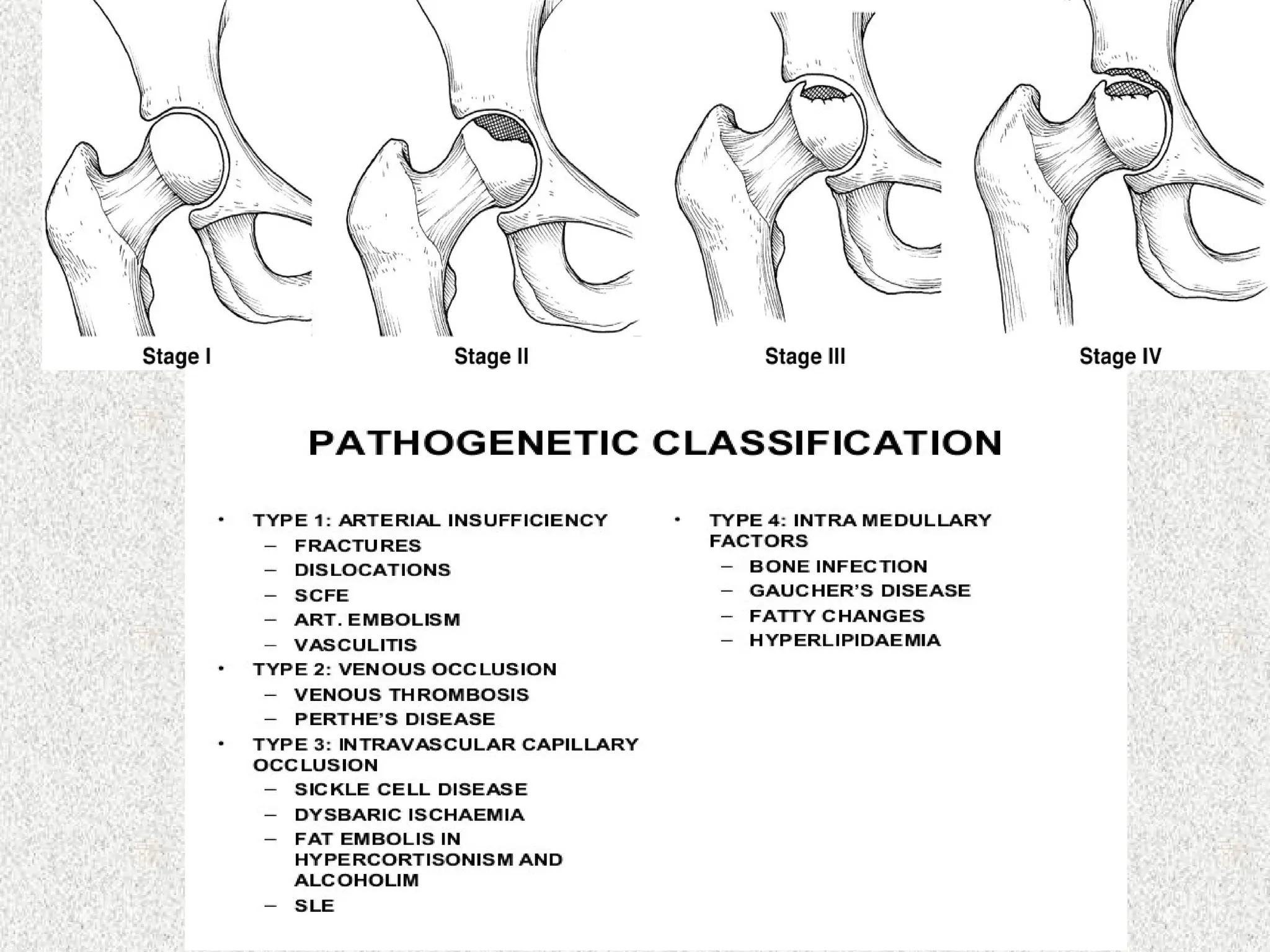 Avascular necrosis of the Femoral head.. | PPTX