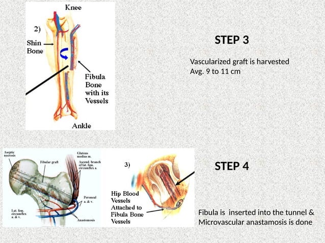 Avascular necrosis of the Femoral head.. | PPTX | Bone and Joint ...