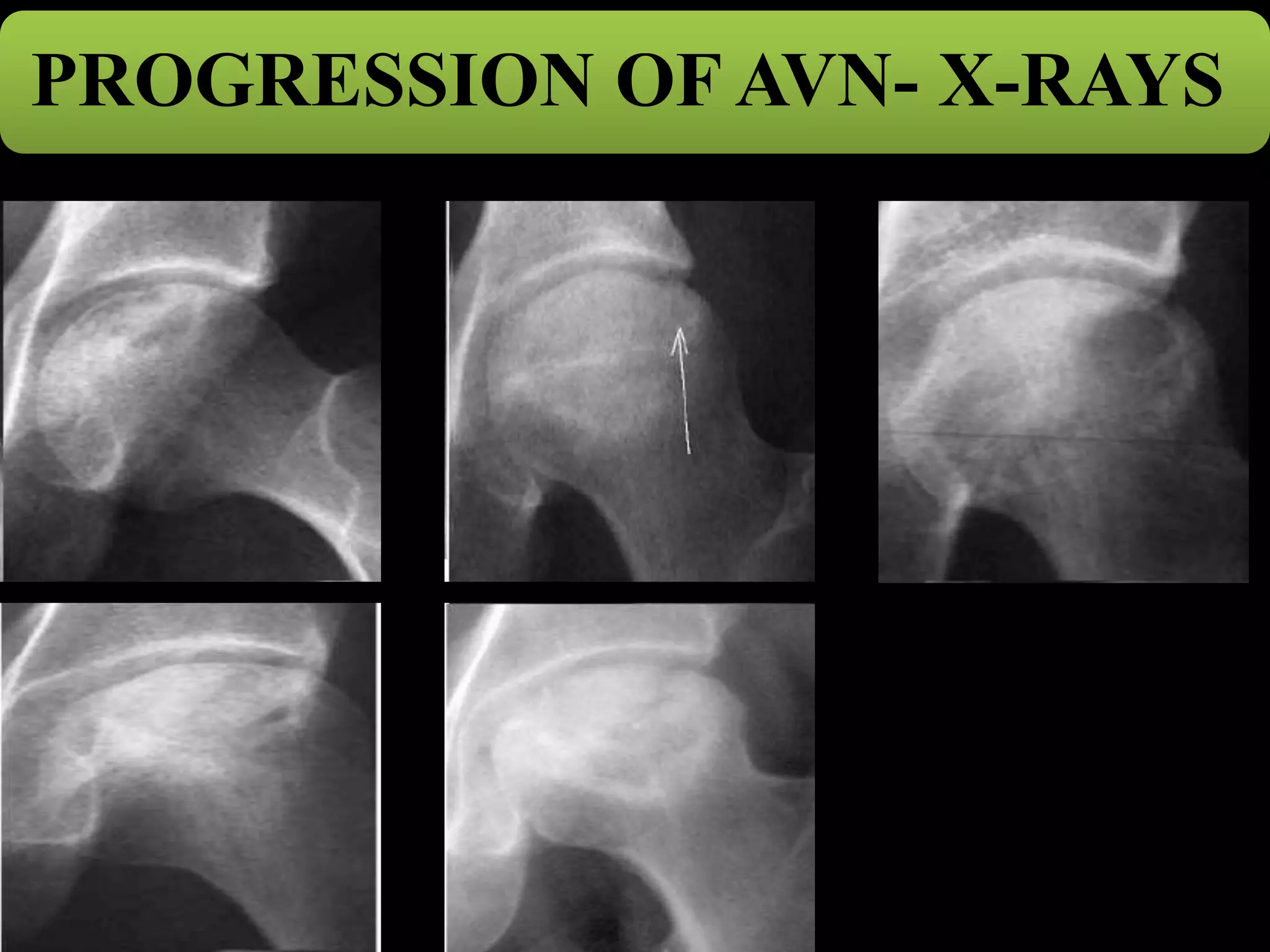 AVASCULAR NECROSIS OF HIP (AVN HIP) | PPTX