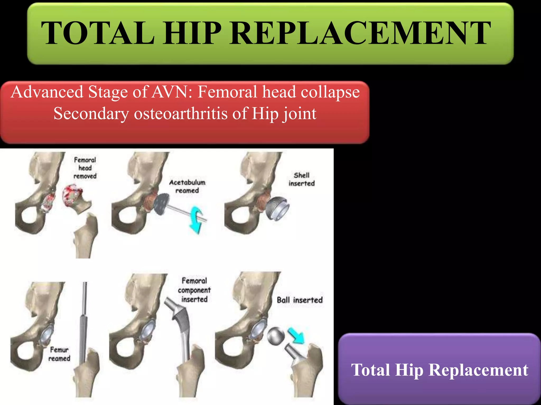 AVASCULAR NECROSIS OF HIP (AVN HIP) | PPTX