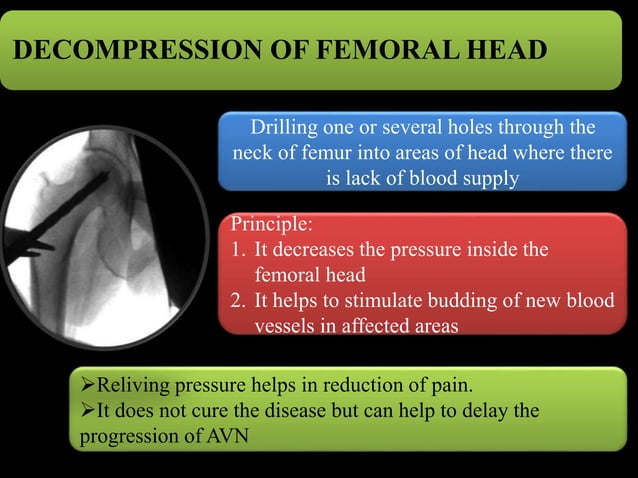AVASCULAR NECROSIS OF HIP (AVN HIP) | PPTX