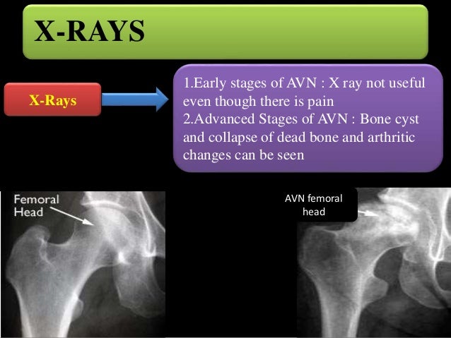 AVASCULAR NECROSIS OF HIP (AVN HIP)