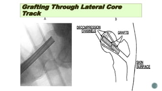 Management of Avascular Necrosis of femoral head at Pre-Collapse stage ...
