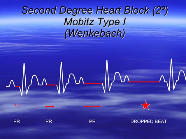 Av nodal blocks | PPT