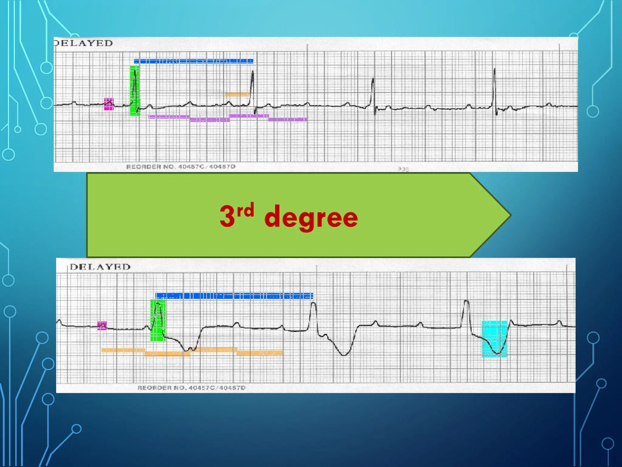 lecture on AV conduction defect of heart | PPT