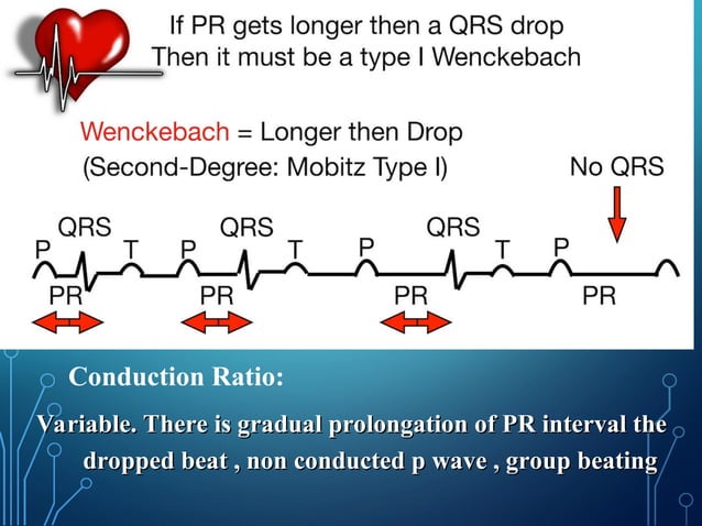 lecture on AV conduction defect of heart | PPT