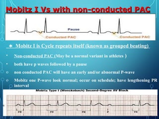 lecture on AV conduction defect of heart | PPT