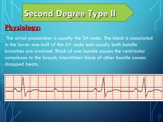 lecture on AV conduction defect of heart | PPT