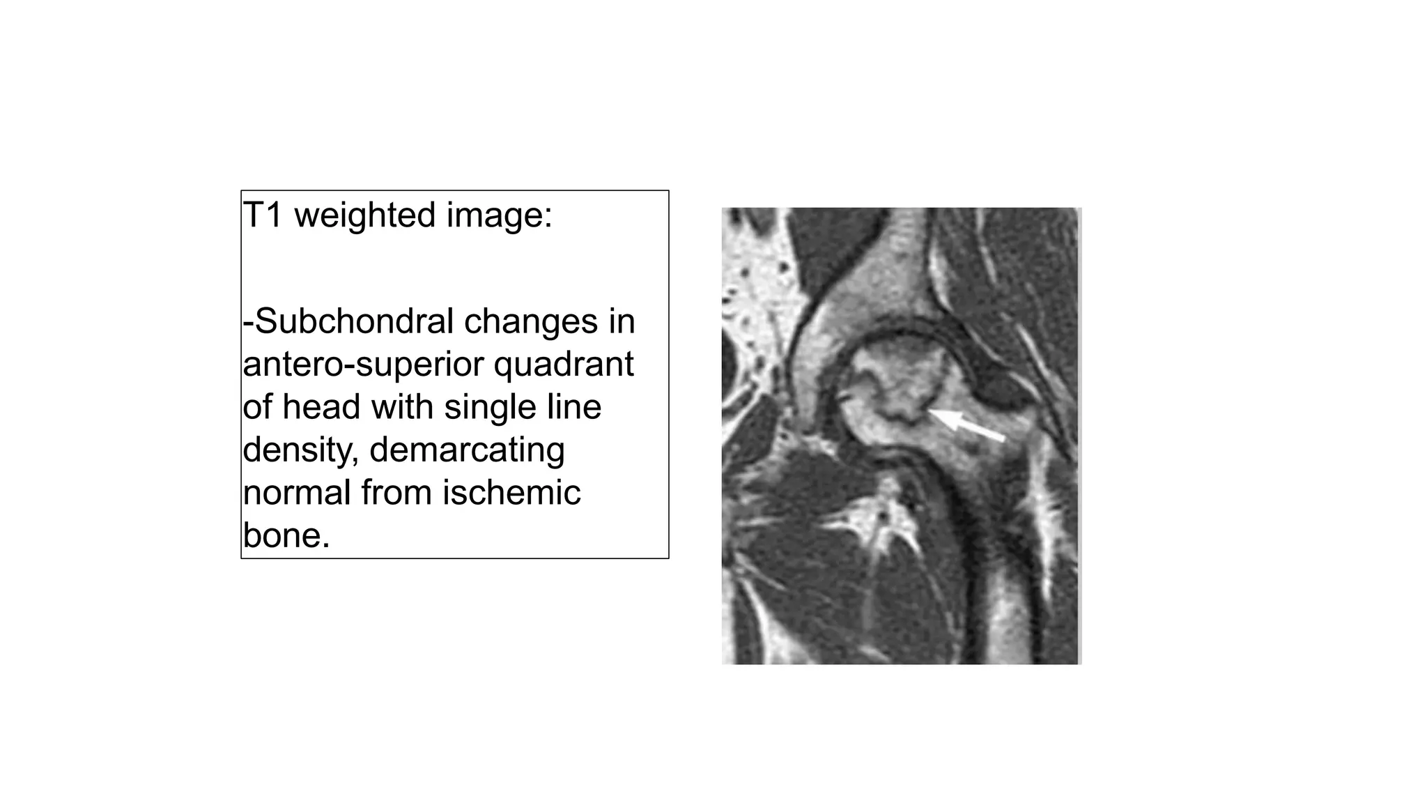 Avn of femoral head | PPTX