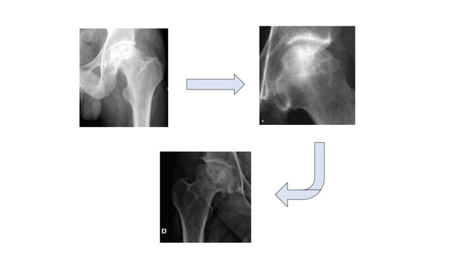 Avn of femoral head | PPTX