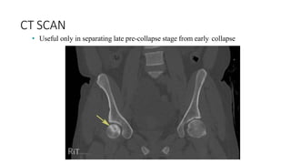 Avn of femoral head | PPTX