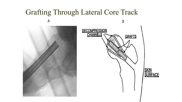 Avn of femoral head | PPTX