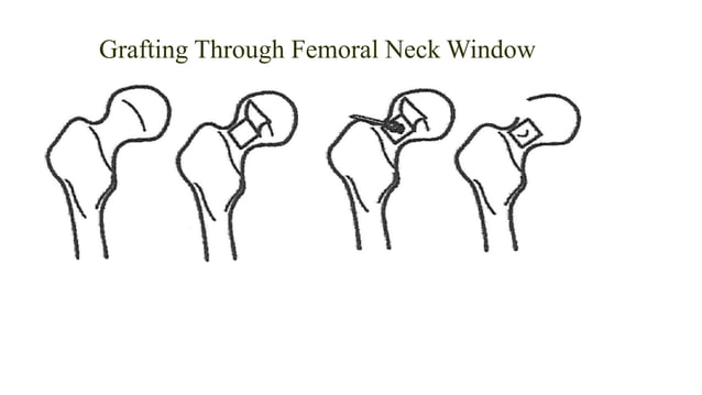 Avn of femoral head | PPTX