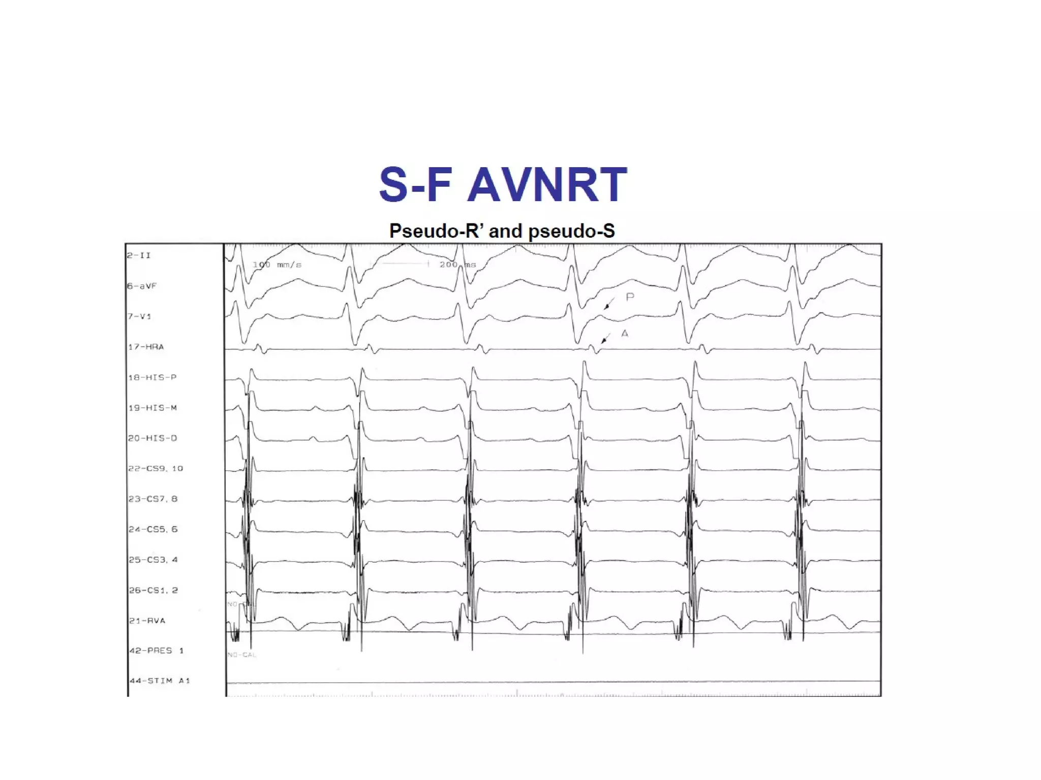 AVNRT | PPT
