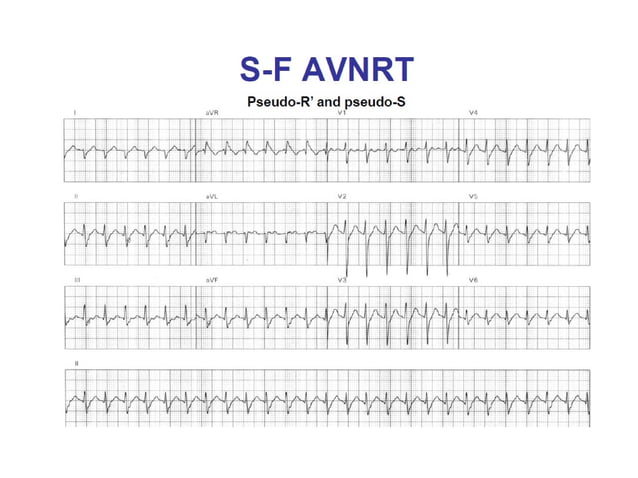 AVNRT | PPT