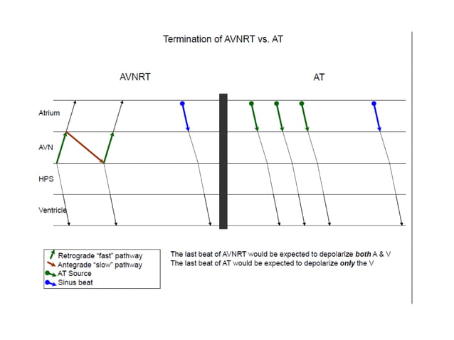 AVNRT | PPT