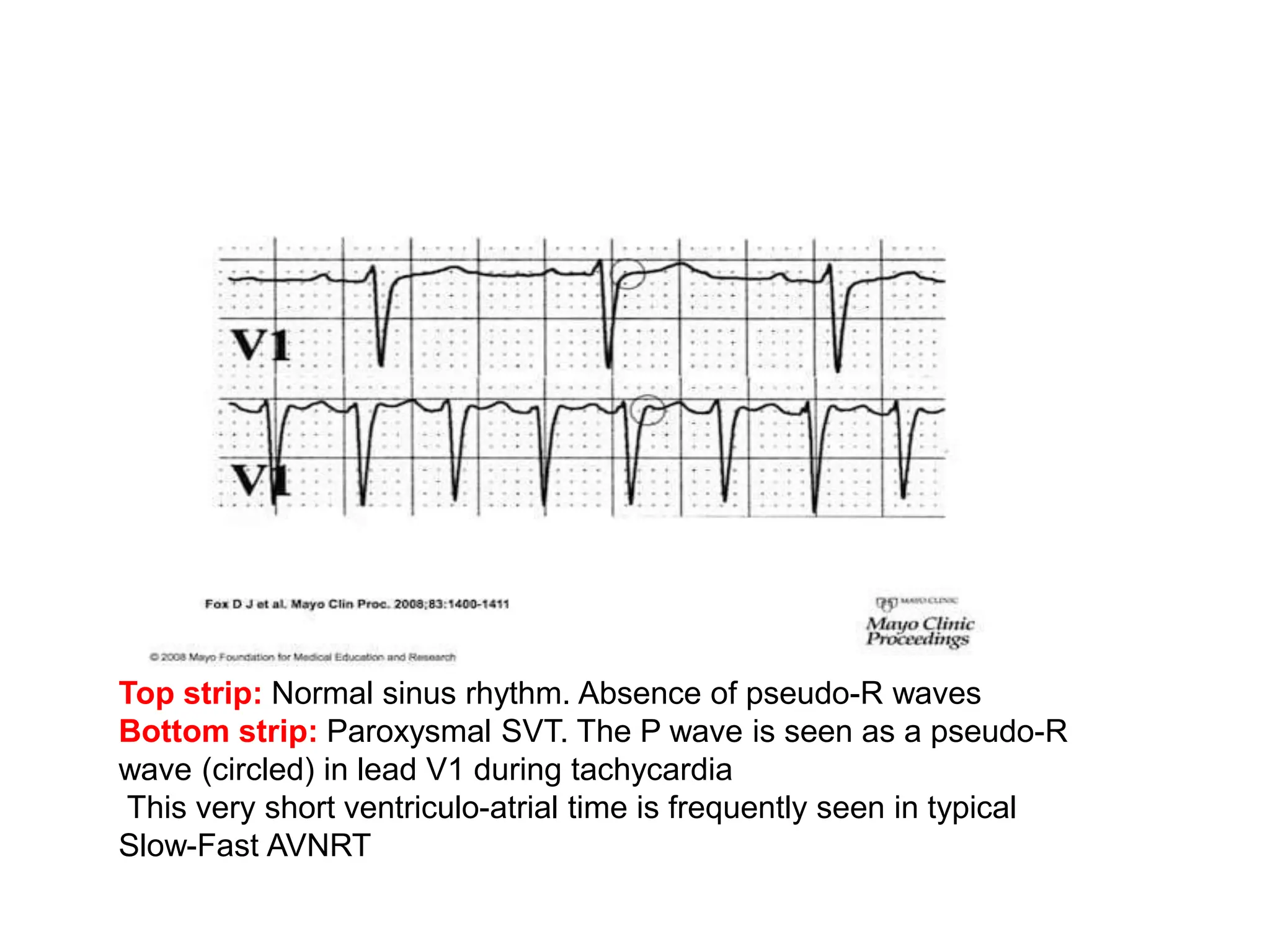 AVNRT,TYPES AND HOW TO INTERPRET IN ECG? | PPTX